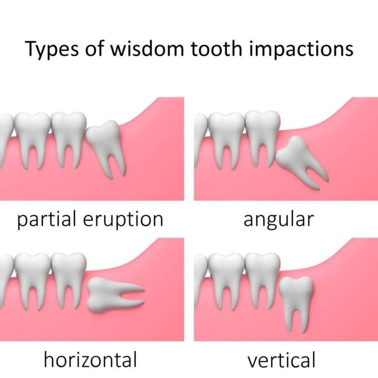5 Reasons You Should Get Your Wisdom Teeth Pulled - Fast Health